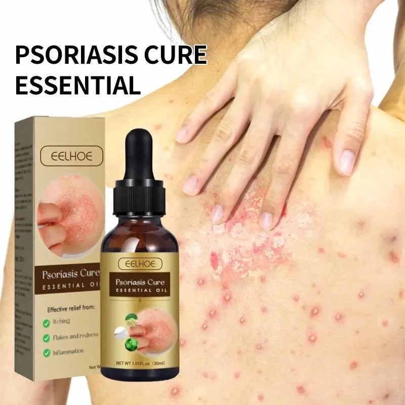 Psoriasis essential oil skin moss repair Hand Foot Dermatitis Eczema ...